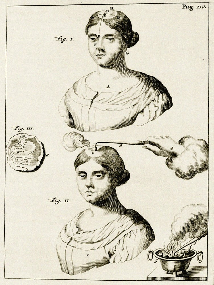 Treating a sufferer of Epilepsy, from Exercitationes Practicae circa ...