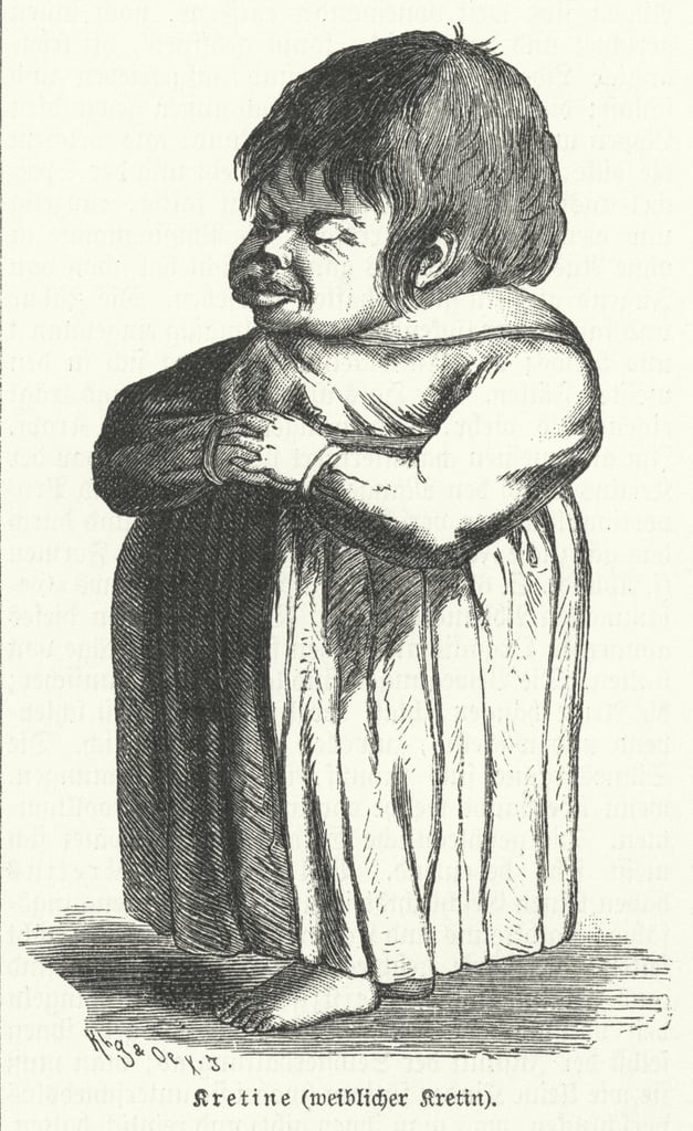 Cretin, woman suffering from congenital iodine deficiency syndome ...