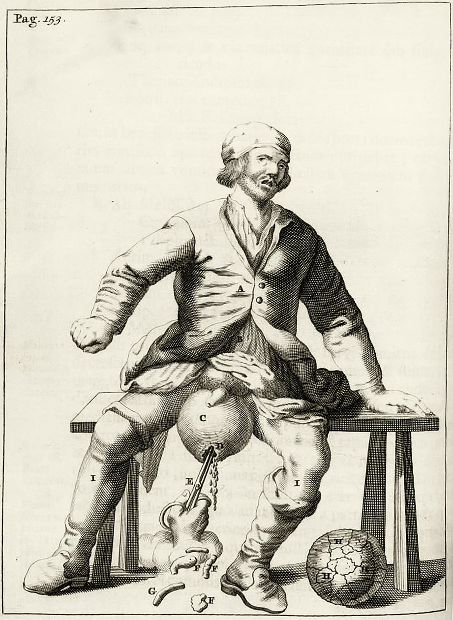 Draining fluid from a Hydrocele of the Scrotum, from Exercitationes ...