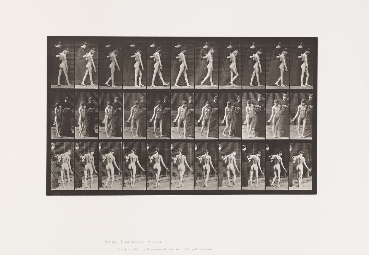 Multiple Cerebro-Spinal Sclerosis (Choreic); Walking (Plate 541)