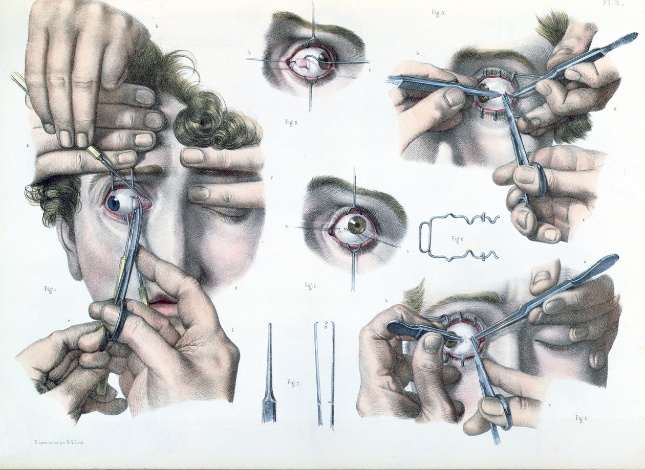 Operation on a strabismus, plate from 'Traite Complet de l'Anatomie de ...