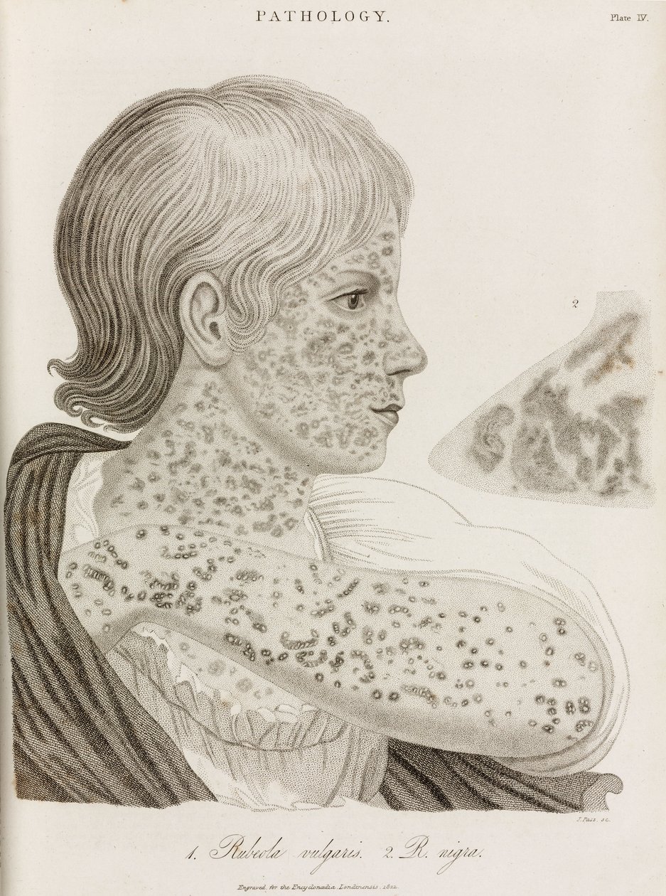 Two Types of Measles by John Pardon: Buy fine art print