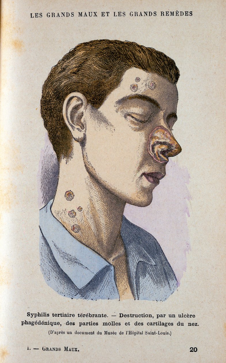 Tertiary Syphilis
