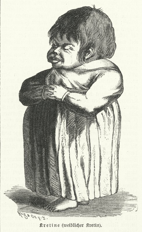 Cretin, woman suffering from congenital iodine deficiency syndrome